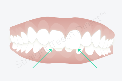 Overbite: wondering if clear aligners could fix yours? Overbite: wondering if clear aligners could fix yours?