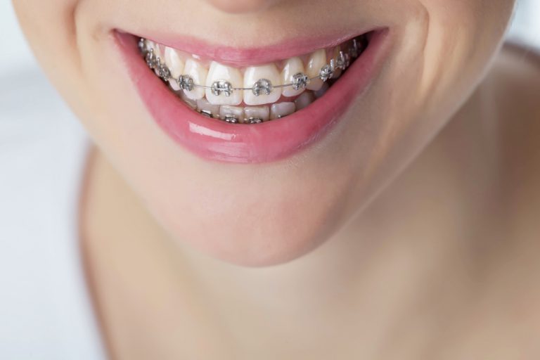 Braces - fixed or removable? 8 points you need to know