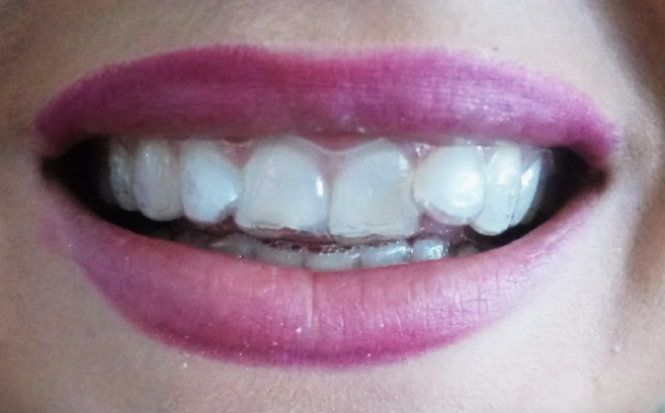 Braces - fixed or removable? 8 points you need to know