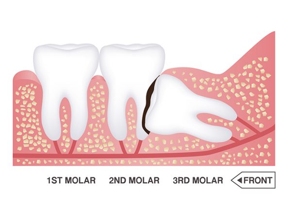 Wisdom teeth and dental braces: myths and realities