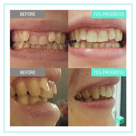 Welcome to Straight Teeth Direct™ - Invisible Aligners Delivered To You