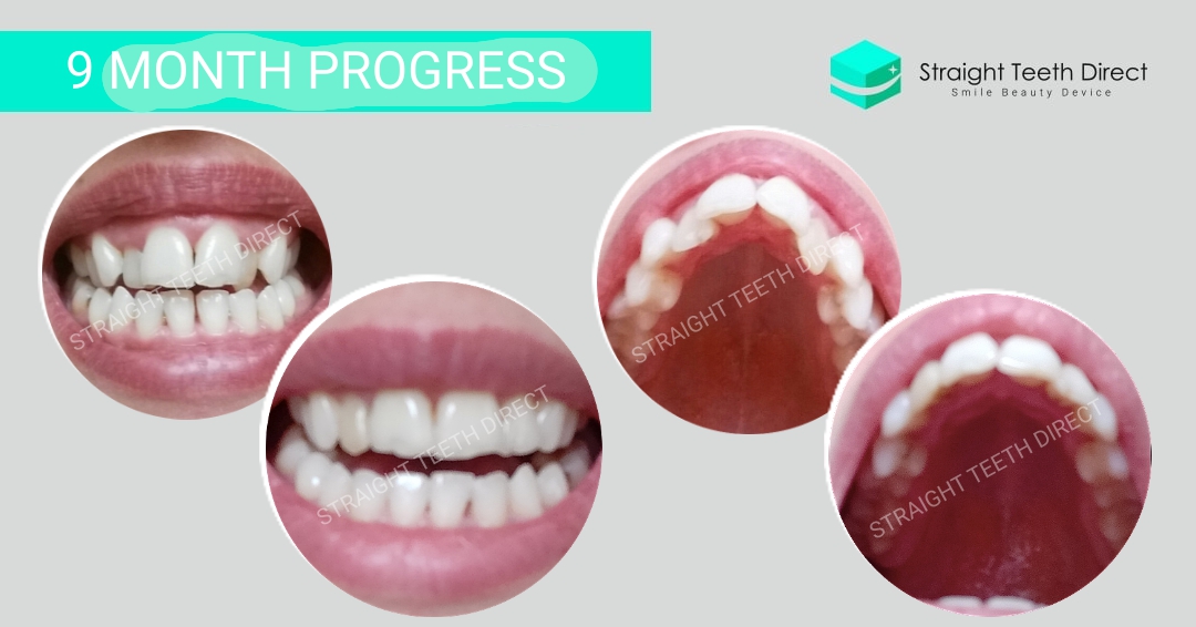 How To Get My Teeth Straight At Home - TeethWalls How To Get My Teeth Straight At Home - TeethWalls