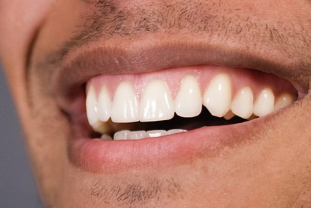 Gum health and teeth straightening - Do you know your gum type?