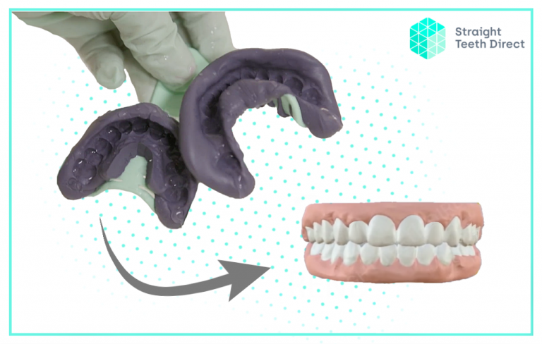 Dental Impressions - Why they are needed to make your invisible aligners