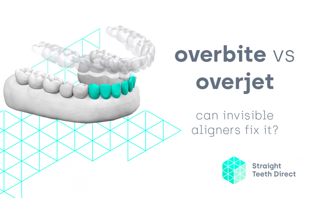 Overjet vs Overbite: what is what and can aligners improve them?