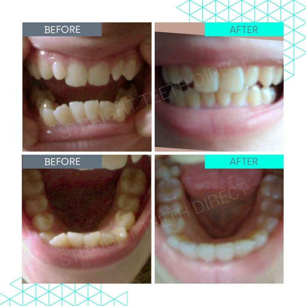 Invisible Teeth Braces - At home teeth straightening made simple