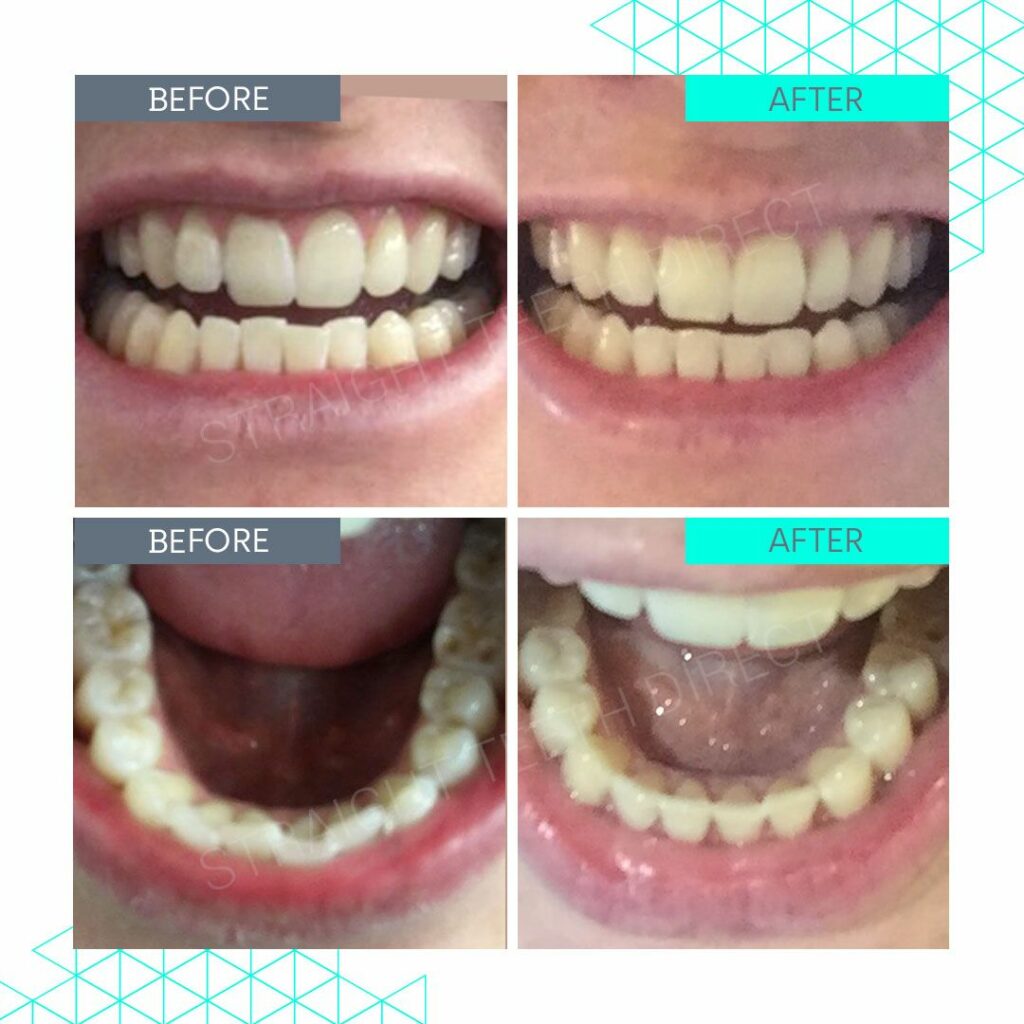 Invisible Teeth Braces - At home teeth straightening made simple