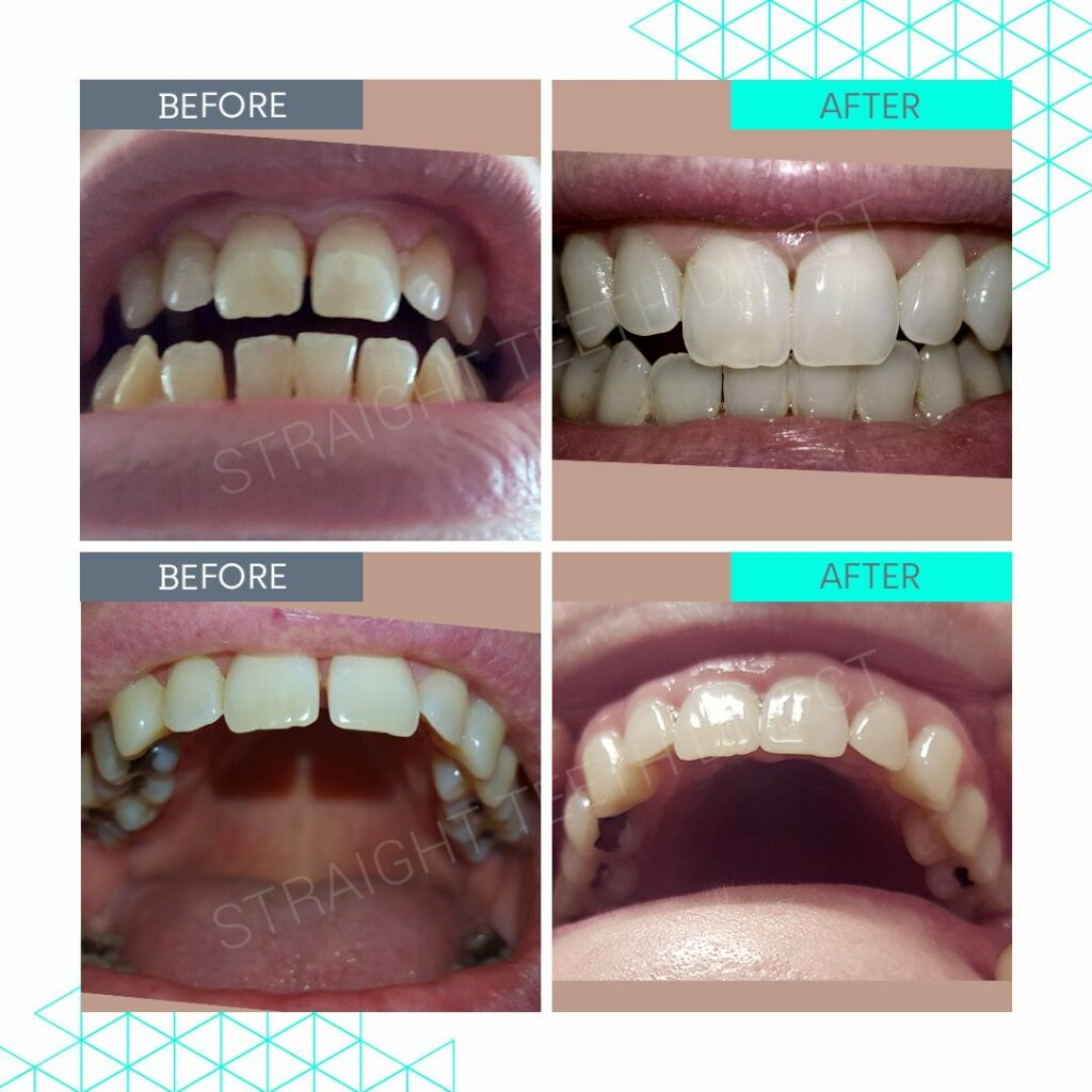 Straight Teeth Direct Pricing - Clear aligners cost made simple